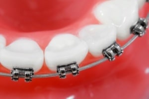 The Process of Applying Braces | Orthodontic Associates