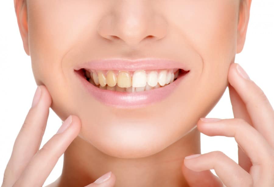 Benefits to Post-braces Tooth Whitening | Orthodontic Associates