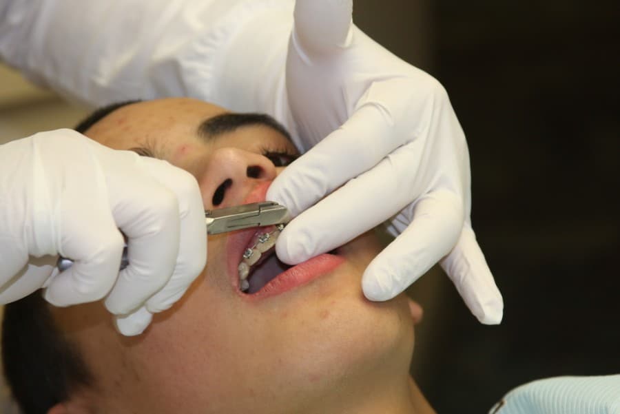 How Are Braces Removed? | Orthodontic Associates
