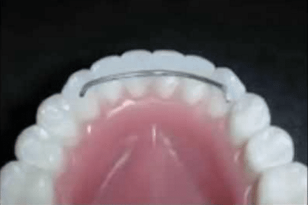 Life After Braces: Plastic and Wire Retainers | Orthodontic Associates