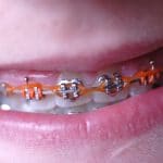 Braces and Power Chains | Orthodontic Associates