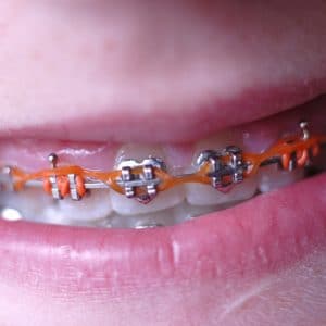 Braces and Power Chains | Orthodontic Associates