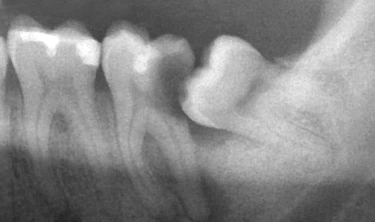 Wisdom Teeth And Braces | Orthodontic Associates