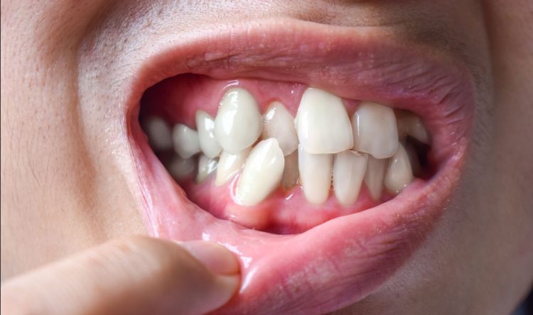 Types of Malocclusions And Orthodontic Treatments Available ...