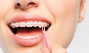 What Is the Purpose of Elastics? | Orthodontic Associates